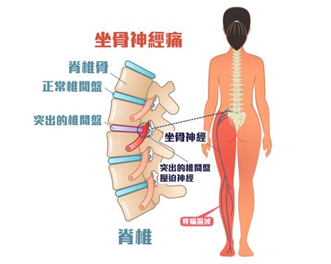 了解坐骨神經痛的症狀，常見成因及治療方法 Mobilize 物理治療中心