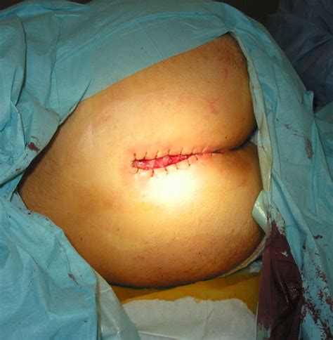 Marsupialization Of A Pilonidal Cyst Doccheck