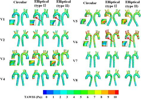 Tawss Distribution In The Eight Patient Specific Aortas With Different
