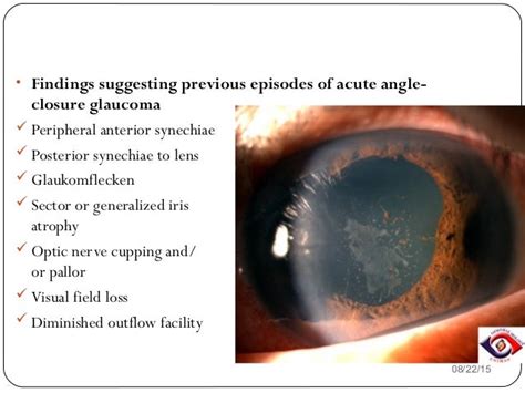 Angle Closure Glaucoma