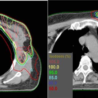 Comparison Of Dose Distribution Calculated Using AAA And AXB Dose Download Scientific Diagram