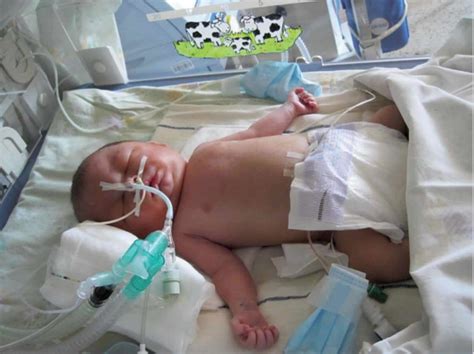 Hydrops Fetalis Causes Diagnosis Ultrasound Treatment And Prognosis