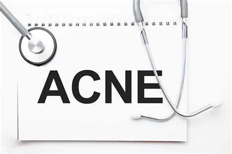 회색 청진기와 종이 접시에는 텍스트 여드름 라이트 블루 백라운드가있는 백서 시트가 있습니다 의료 개념 여드름에 대한 스톡 사진 및 기타 이미지 Istock