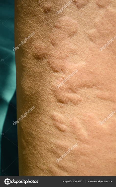 Erupción Cutánea Urticaria Reacción Alérgica Cutánea Fotografía De