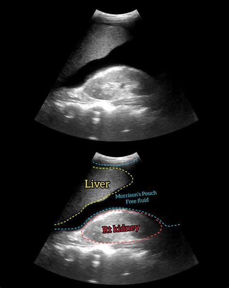 Ultrasound Pocus Morisonspouch Freefluid Daniel Ben Mordechay