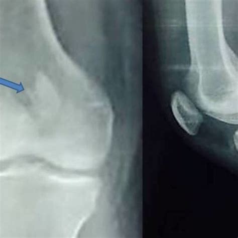 Classification Of Hoffa Fracture By Lewis Et Al 4 Classification Of Download Scientific