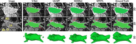Qualitative Comparison Of Left Atrium Segmentation Result In 2d As Well Download Scientific