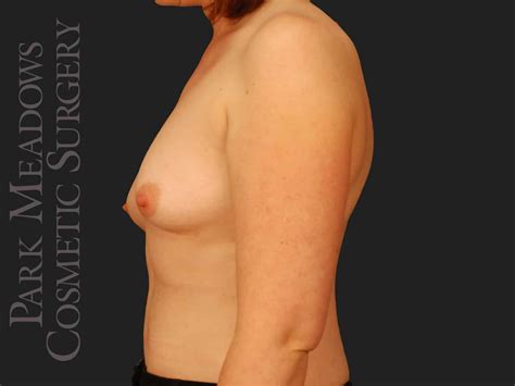 Before And After Gallery Case 6234