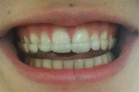 Tmj Treatment Bruxism Splint — Cjn Dentistry