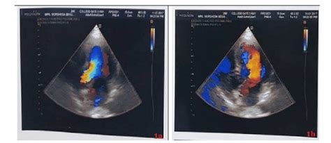 Transthoracic Color Doppler Echocardiography 1a 1b Continuous Flow Download Scientific