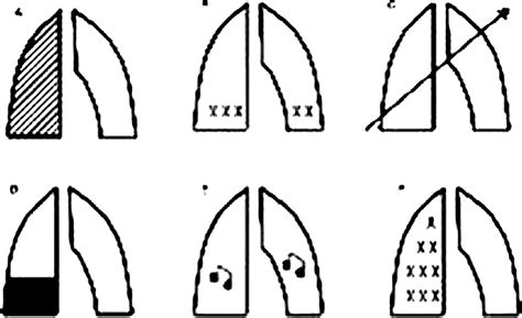 Neonatal Lung Sounds Diagram