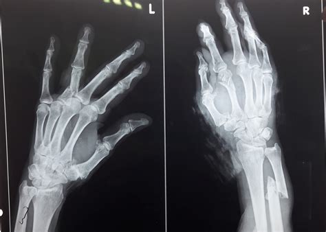 A Case Of Multiple Bone Fractures In Right Upper Extremity With