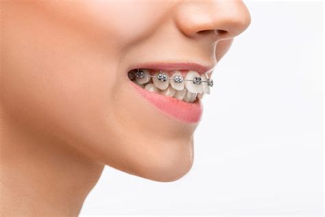 Overbite Vs Normal Symptoms And Treatment Hunt Dentistry