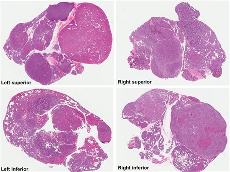 Primary Hyperparathyroidism Histology