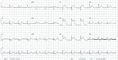 3 Anterior St Segment Elevation Ecg More Marked St Segment Elevation V