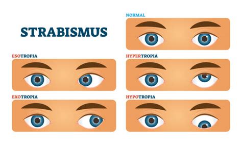 Strabismus Illustrations Royalty Free Vector Graphics And Clip Art Istock