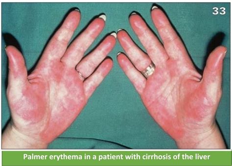 Cholangitis A Patient With Right Medical Education Facebook