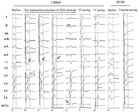 Evaluation Of Clinical Safety And Efficacy Of Left Bundle Branch Area Pacing In Comparison With