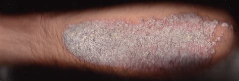Psoriasis —