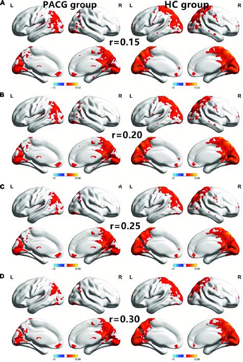 The Spatial Of The Dc Within The Pacg And Hc With Different Correlation Download Scientific