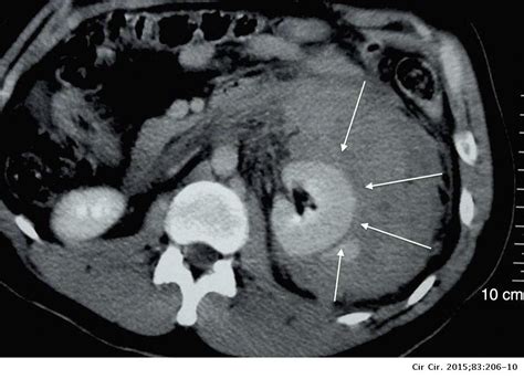 Retroperitoneal Bleed