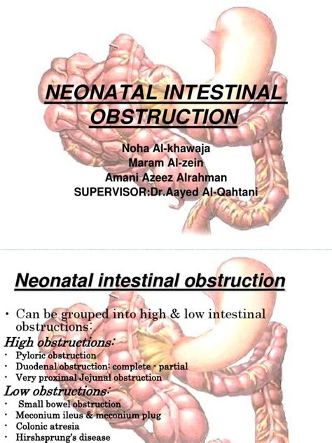 Neonatal Intestinal Obstruction Pdf Pancreas Gastroenterology