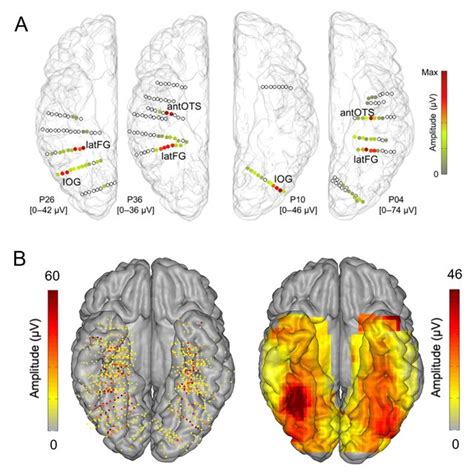 Individual Anatomical Localization Of Seeg Electrodes A Left Panel Download Scientific