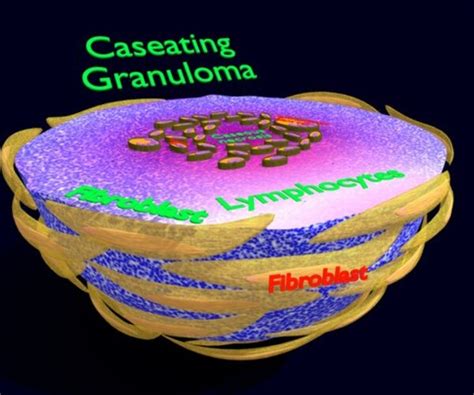 Artstation 3d Caseating Granuolma Tuberculosis Labelled Model Resources