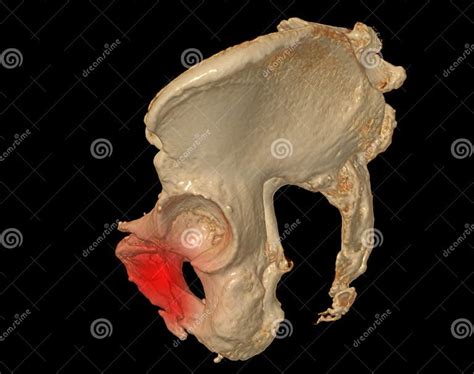 Ct Scan Of Pelvic Bone 3d Rendering Image Showing Superior Pubic Ramus