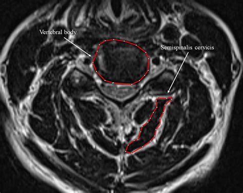 Measurement Of The Cross Sectional Area Of The Semispinalis Cervicis Download Scientific