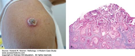 Pathology Of The Skin Basicmedical Key