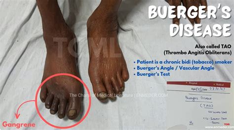 Buerger Disease Ancaman Serius Bagi Pembuluh Darah