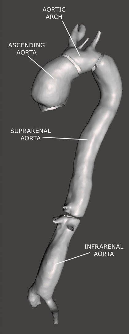 3d Aortic Dissection Model Turbosquid 2050738