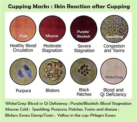 Cupping Therapy Color Meanings Uajet
