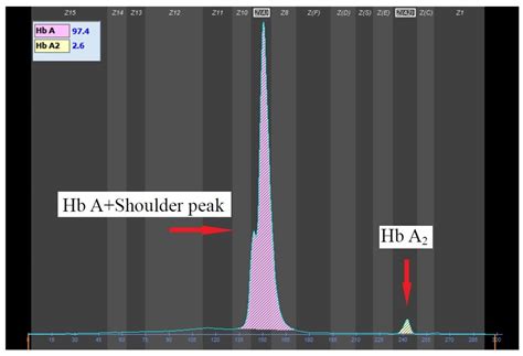 Capillarys 2 Flex Piercing Detected A Rare Case Of Hb Broomhill