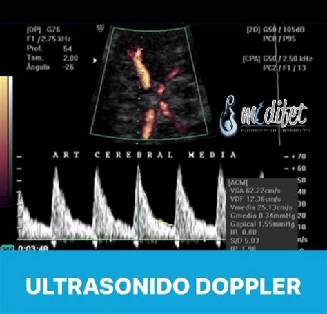 ¿Sabes cuál es la función del Ultrasonido Doppler? Con este tipo de ultrasonido se evalúa el ...