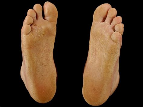 Keratoderma Palmoplantar Epidermolytic