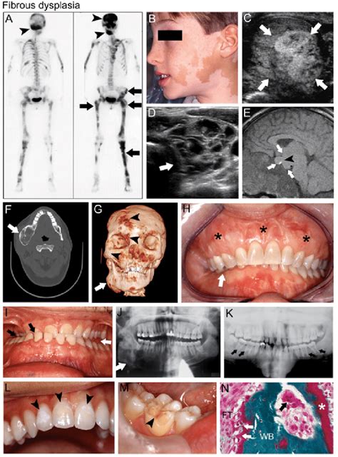 Fibrous Dysplasia Of Bone