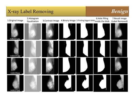 Microcalcification Identification In Digital Mammogram For Early