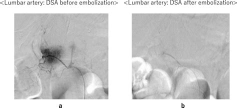 Example Of Arterial Embolization A Lumbar Artery Dsa Before