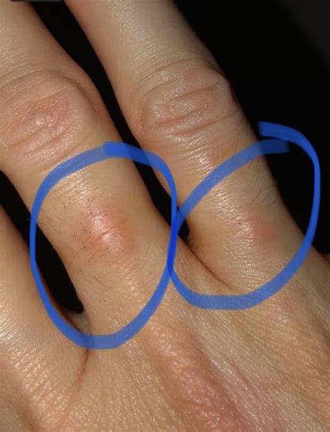 Not Exactly A Ring Rash Rdermatologyquestions
