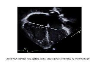 Echo Of Repaired Tof Pptx