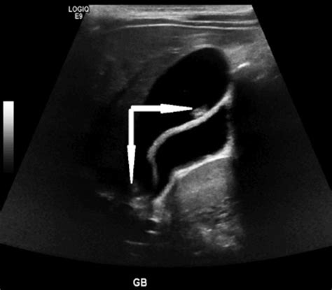 Gall Bladder Stone What Are Gall Bladder Stones Gallbladder Stone