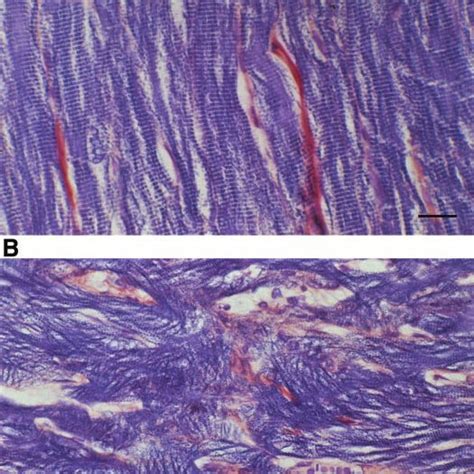 Histological Evidence For Myocyte Disarray Transverse Sections Through