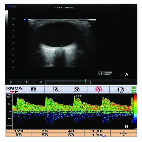 A Measurement Of Optic Nerve Sheath Diameter Onsd Onsd Was Download Scientific Diagram