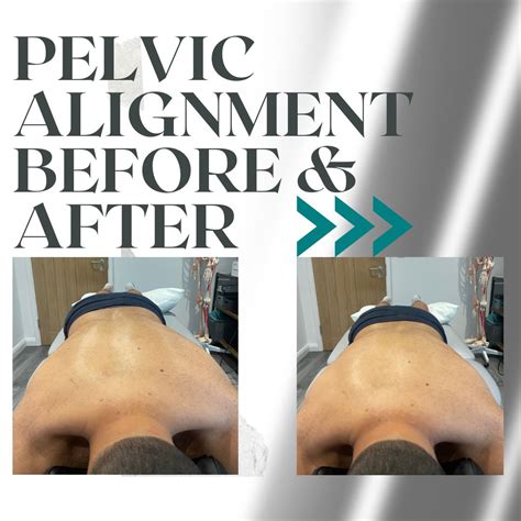 Before And After Pelvic Realignment Chela Collingbourne