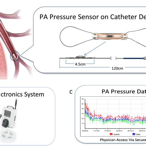The Cardiomems Tm Hf System Sensor Is Permanently Implanted Into The