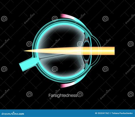 Farsightedness Eye Disease Stock Illustration Illustration Of