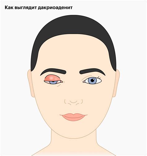 Дакриоцистит новорожденных: причины, симптомы, методы лечения, профилактика