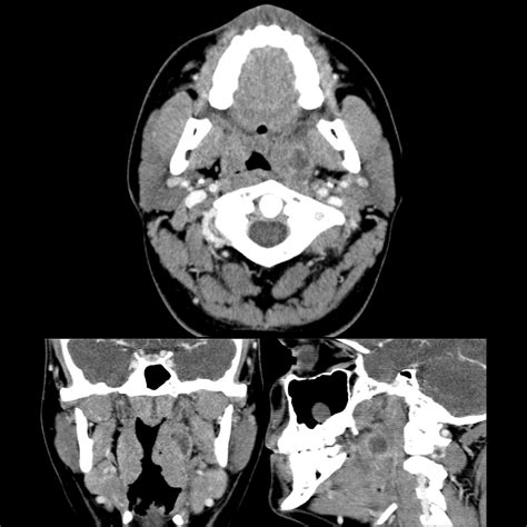 Pediatric Peritonsillar Abscess Pediatric Radiology Reference Article